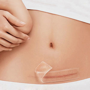 Los mejores parches de silicona para cicatrices